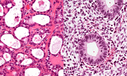 Ovarian Cancer Research Foundation - News - Is there a connection ...